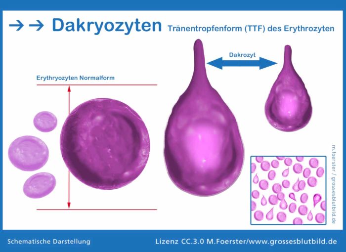 Erkrankung der Erythrozyten (Sonderformen) » Dr. Stephan