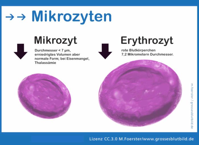 Erkrankung der Erythrozyten (Sonderformen) » Dr. Stephan